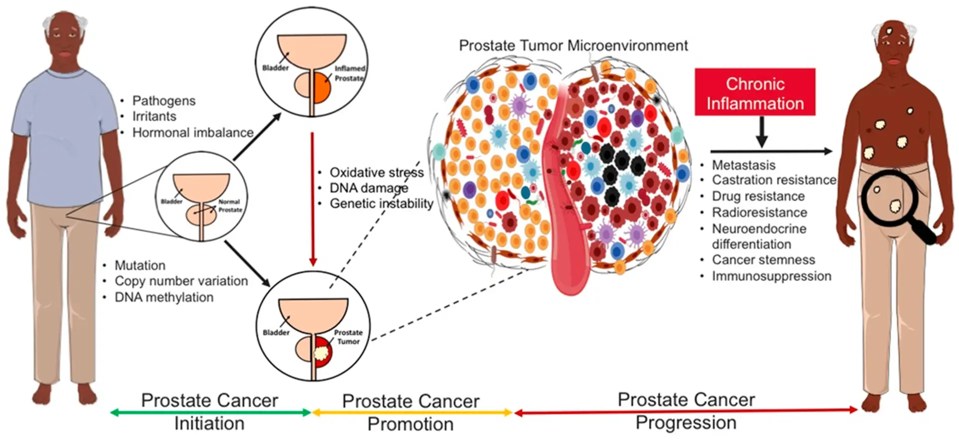 The Link Between Inflammation and Prostate Hyperplasia: What You Should ...