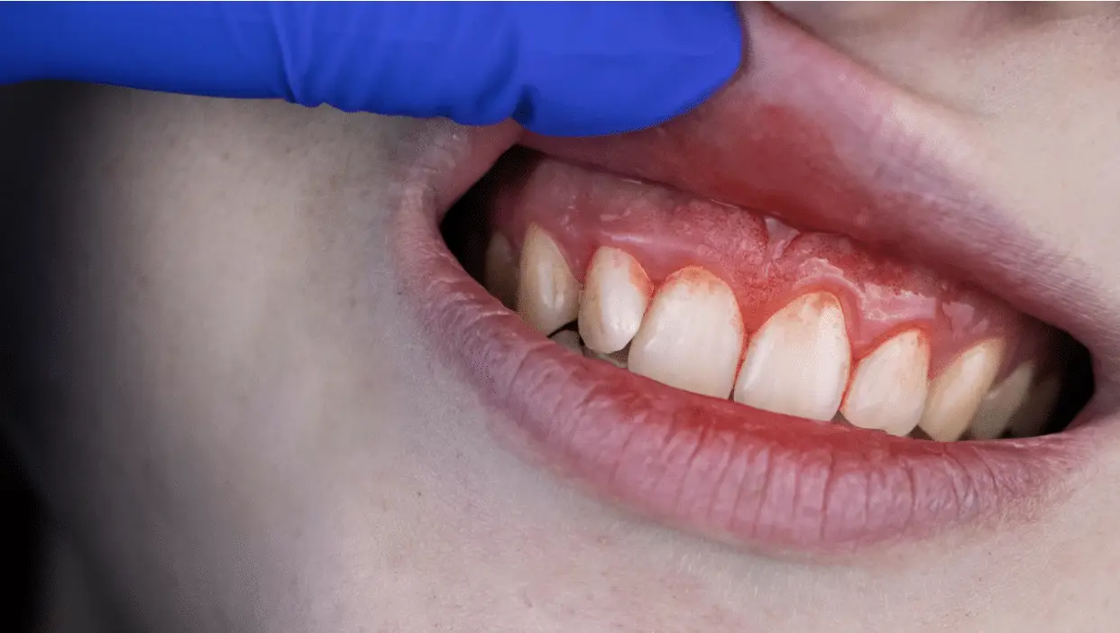 Gingivitis: What It Is, How to Spot It, and How to Treat It Naturally ...